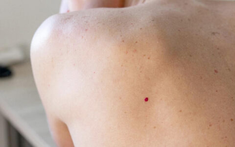 Laser - Angiomes Rubis - Le centre de la silhouette: Laser ...